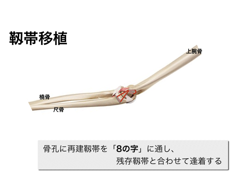 肘関節内側側副靱帯（MCL）再建術 | AR-Ex 尾山台整形外科