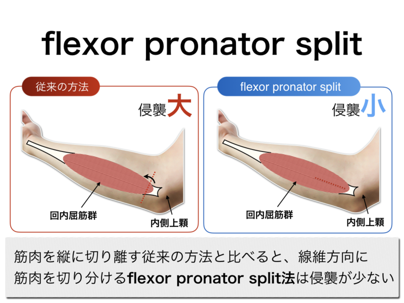 肘関節内側側副靱帯（MCL）再建術 | AR-Ex 尾山台整形外科